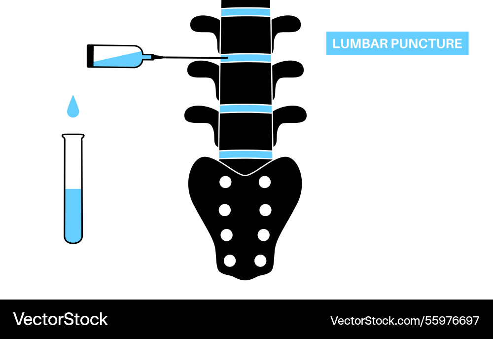 Lumbar puncture spinal tap Royalty Free Vector Image