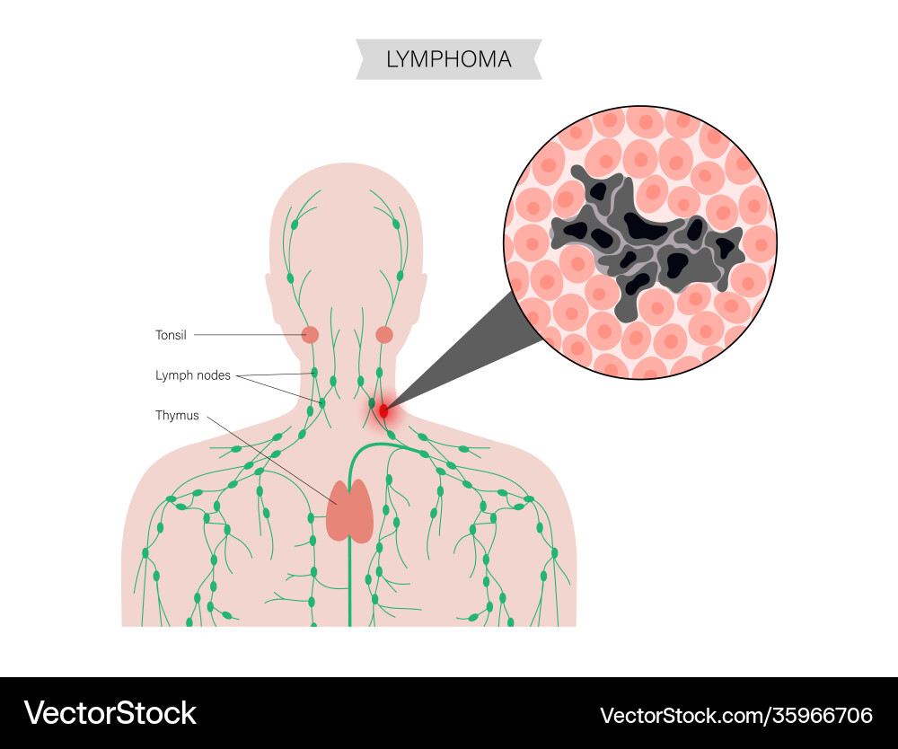 Lymphoma cancer concept Royalty Free Vector Image
