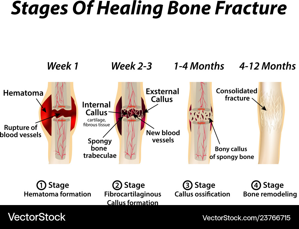 Bone Fracture Healing Stages - Callus Formation Vector Image