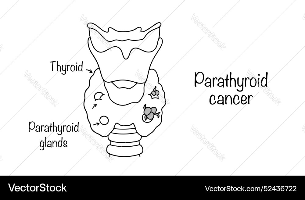 Parathyroid cancer Royalty Free Vector Image - VectorStock
