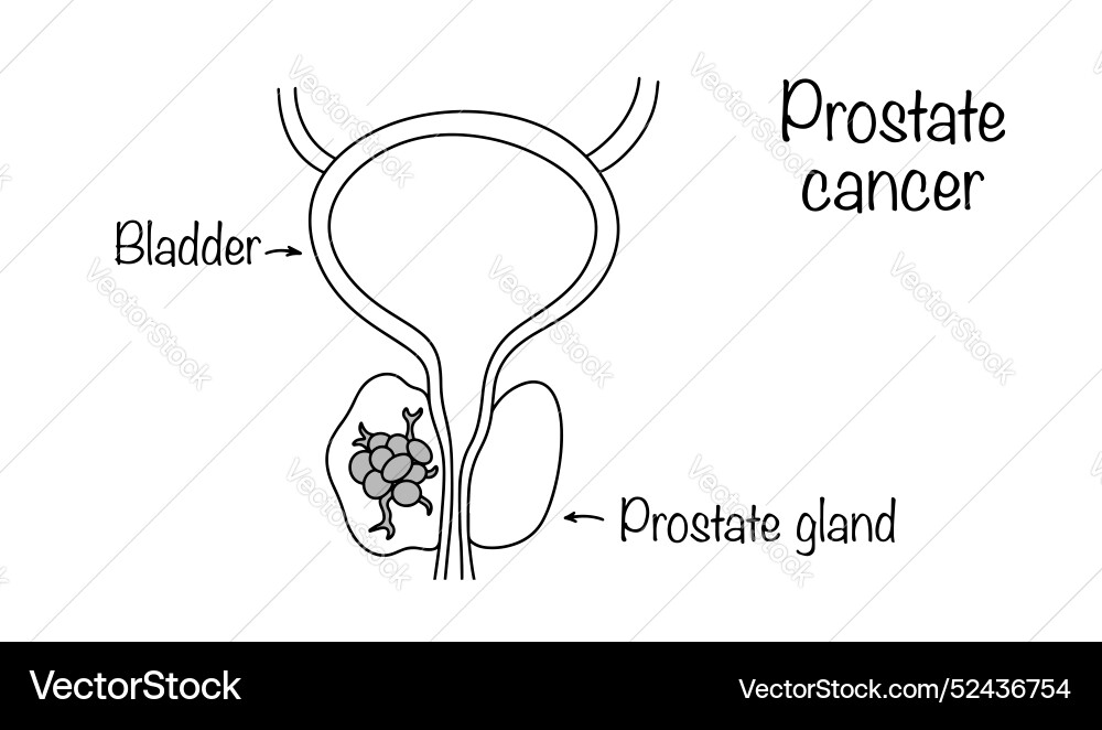 Prostate cancer Royalty Free Vector Image - VectorStock