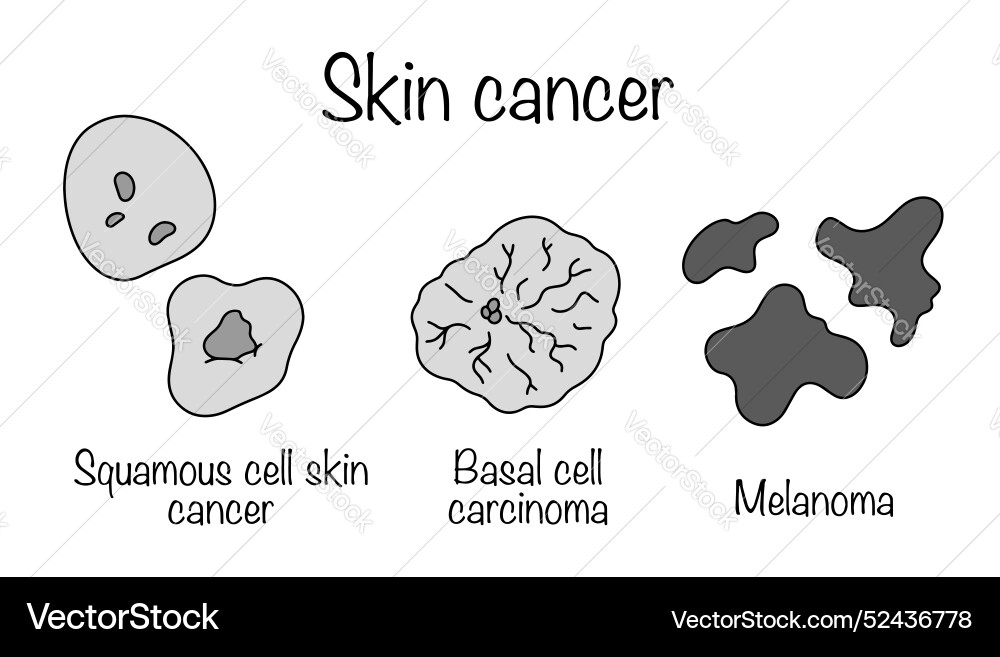 Skin cancer Royalty Free Vector Image - VectorStock