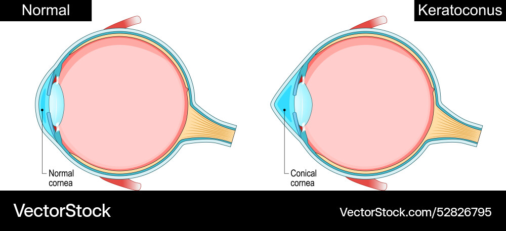 Keratoconus eye disorder corneal thinning Vector Image