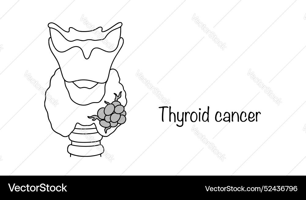 Thyroid cancer Royalty Free Vector Image - VectorStock
