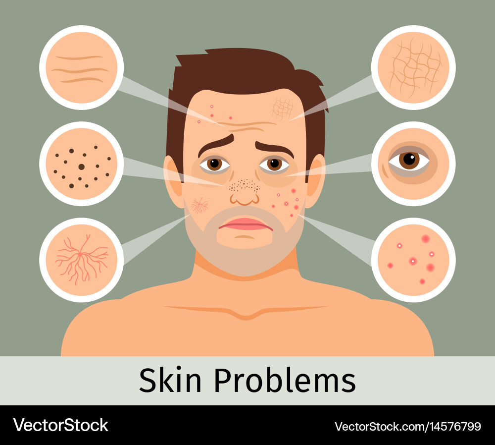 Male facial skin problems Royalty Free Vector Image