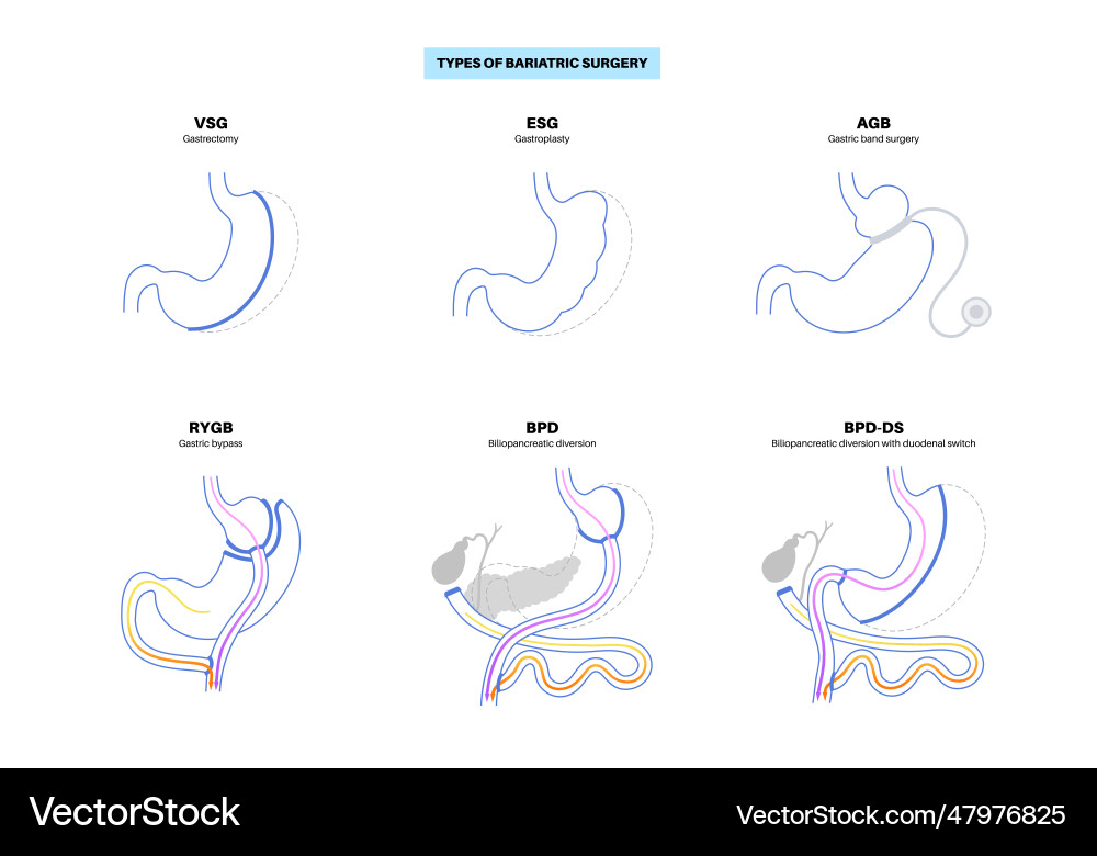 Bariatric Surgery Types Royalty Free Vector Image