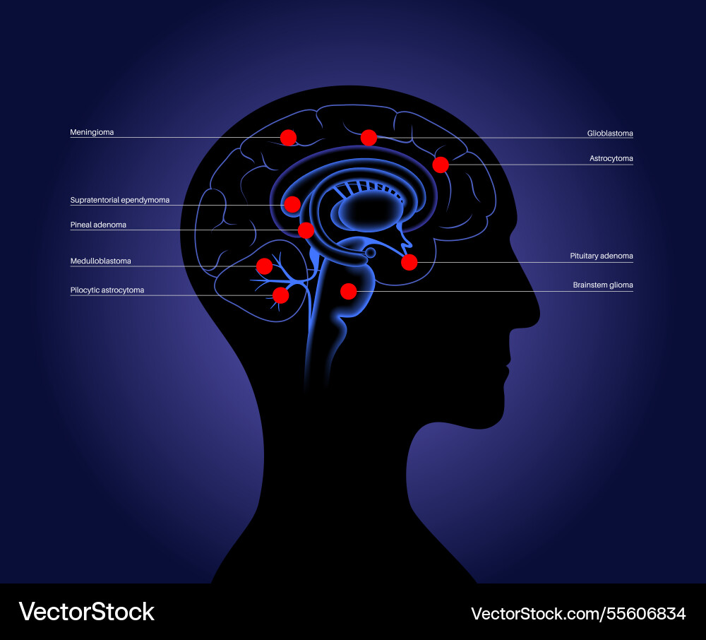 Primary brain tumors Royalty Free Vector Image