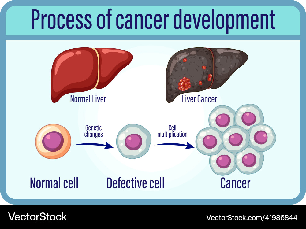 Process of cancer development Royalty Free Vector Image