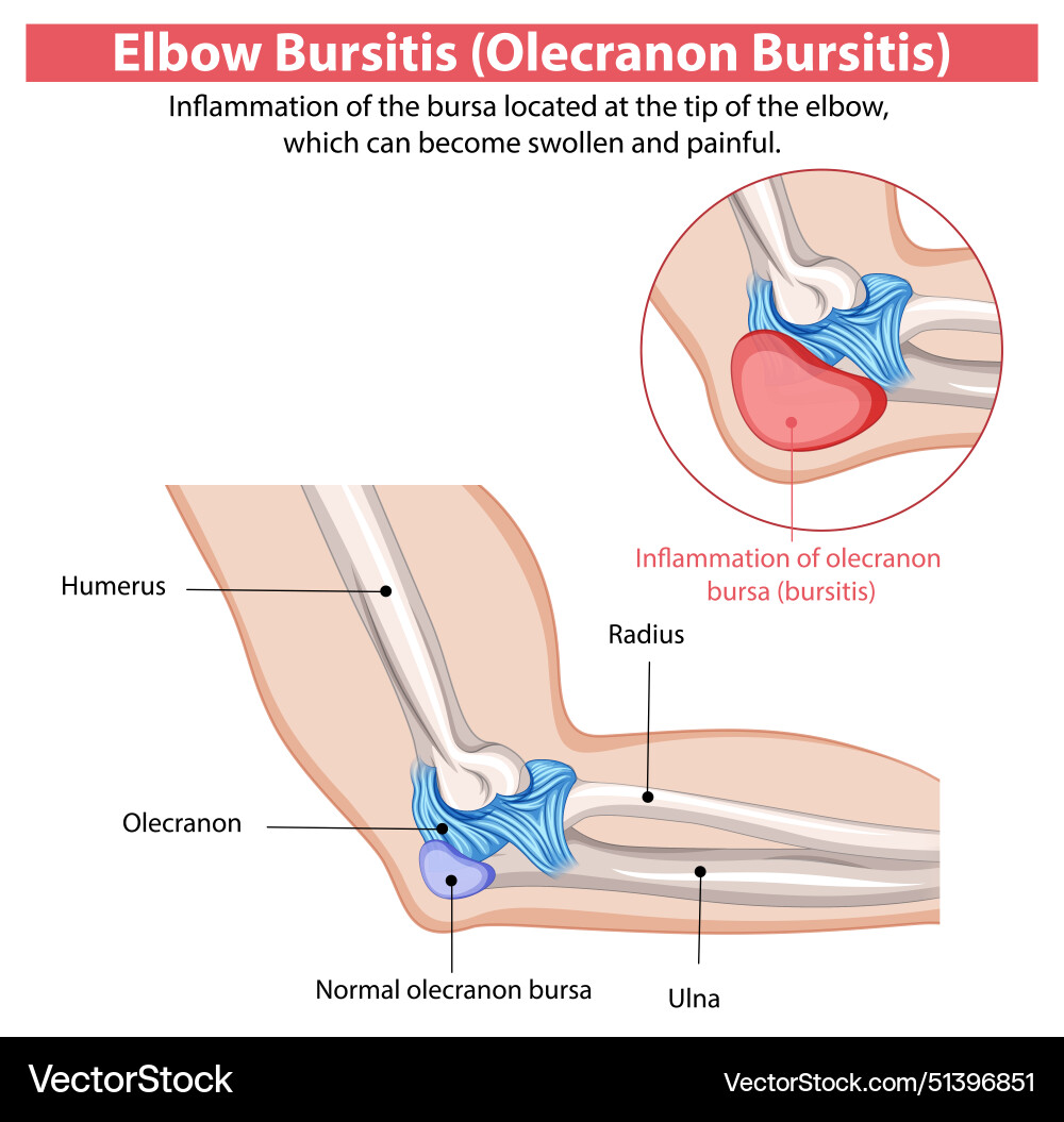Inflammation of the olecranon bursa in the elbow Vector Image