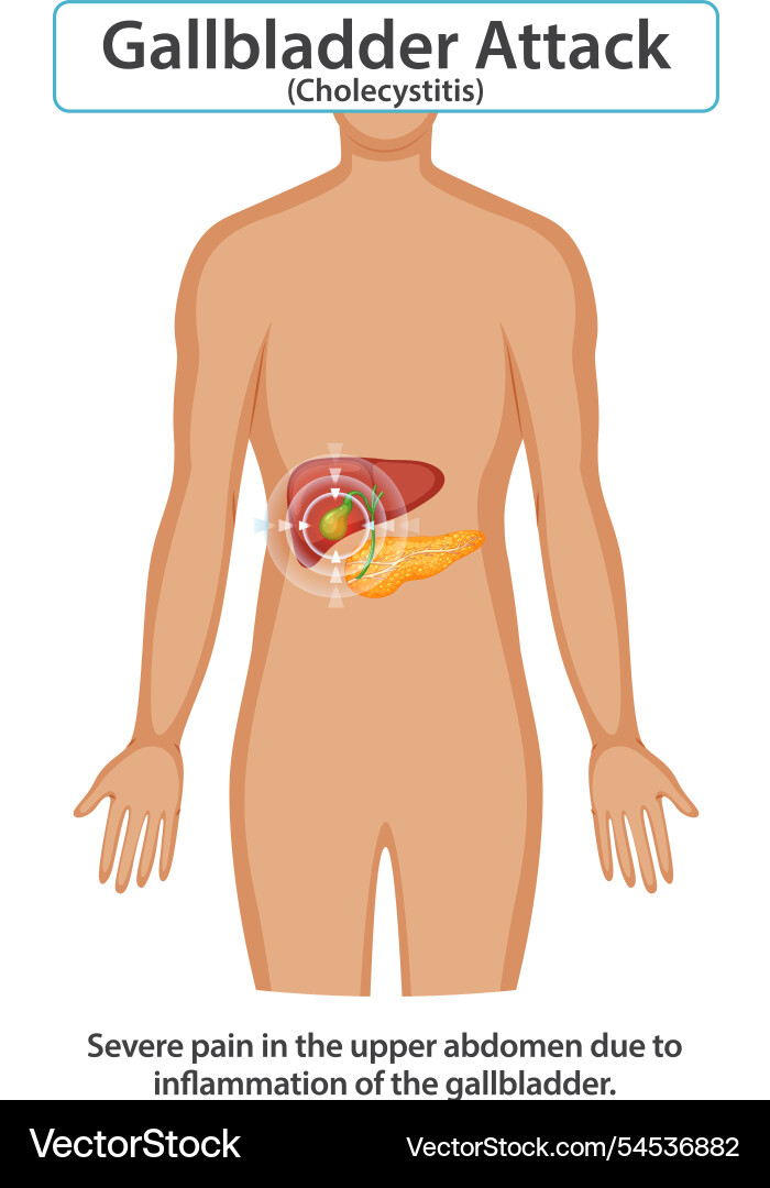 Gallbladder inflammation and abdominal pain Vector Image
