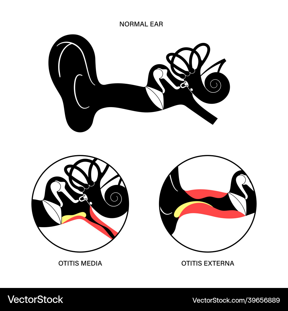 External Ear Otitis Media Royalty Free Vector Image