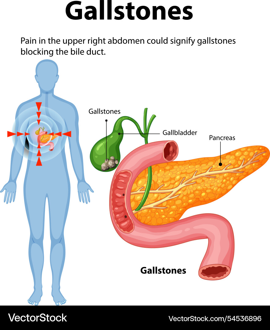 Gallstones affecting the bile duct Royalty Free Vector Image