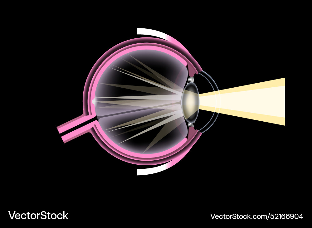 Cataract eye disease Royalty Free Vector Image