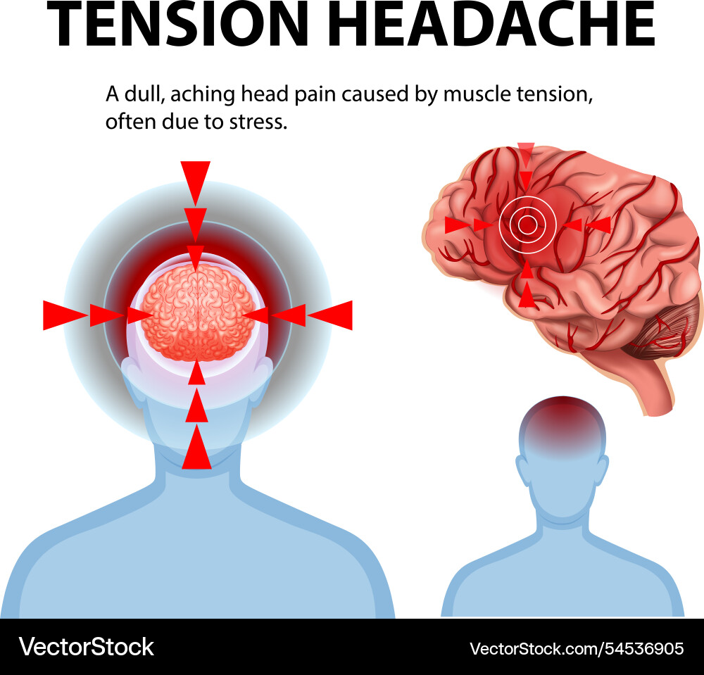 Tension headache symptoms and brain anatomy Vector Image