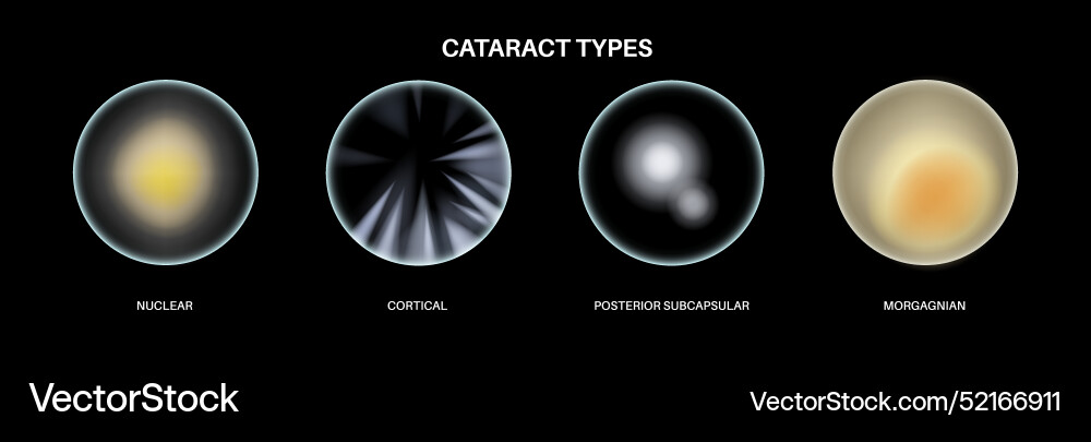Cataract eye disease Royalty Free Vector Image