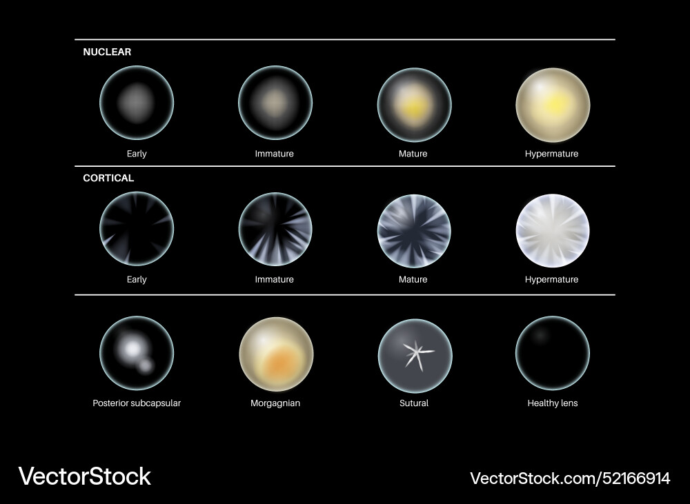Cataract eye disease Royalty Free Vector Image