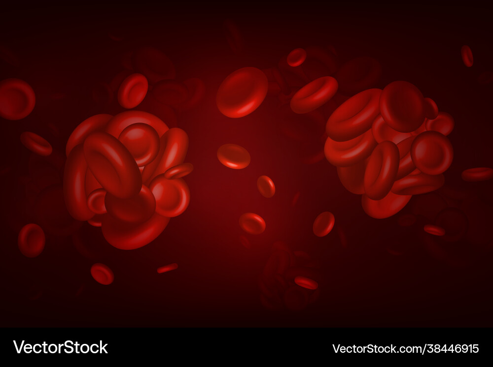 Blood Clot Thrombus Embolism Royalty Free Vector Image