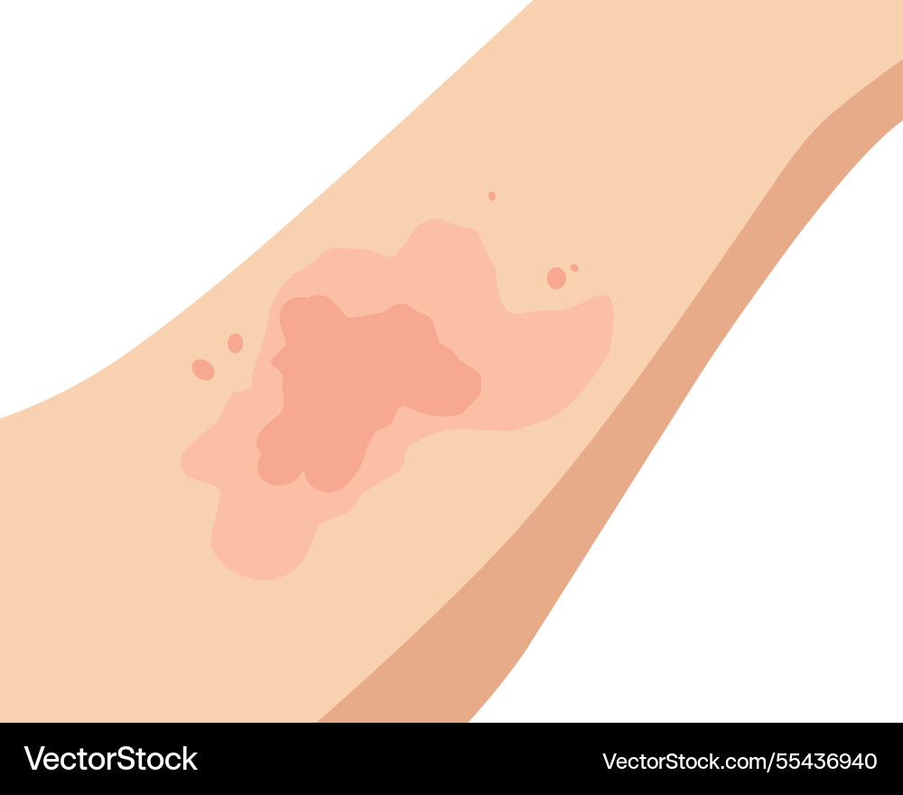 An allergic reaction Royalty Free Vector Image