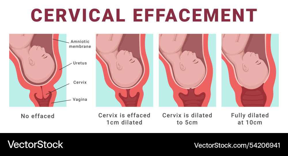 Cervical effacement human childbirth steps medical