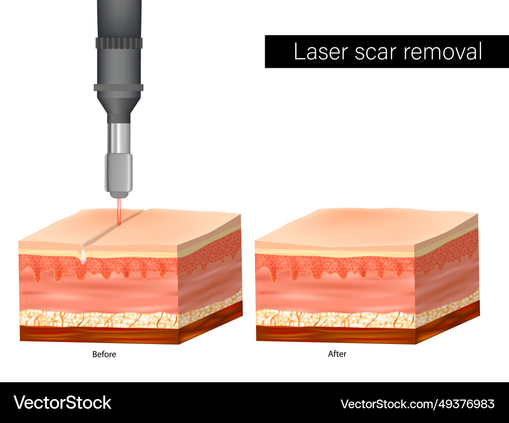 Laser Narbe Entfernung vor und nach Lizenzfreier Vektor