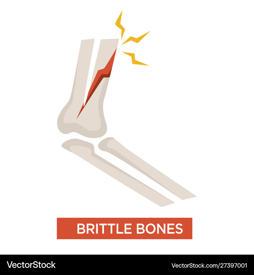 Brittle bones osteoporosis health issue concept Vector Image