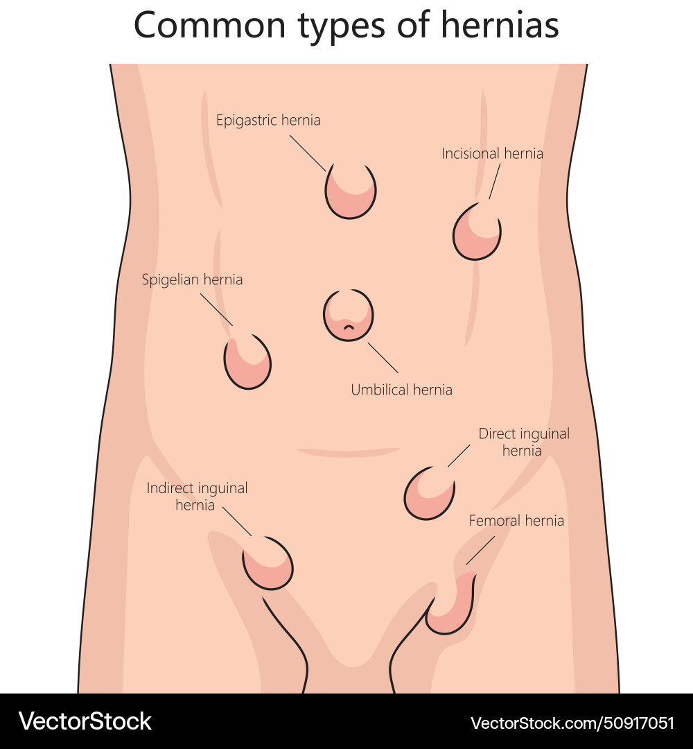 Common types of hernias diagram medical science Vector Image