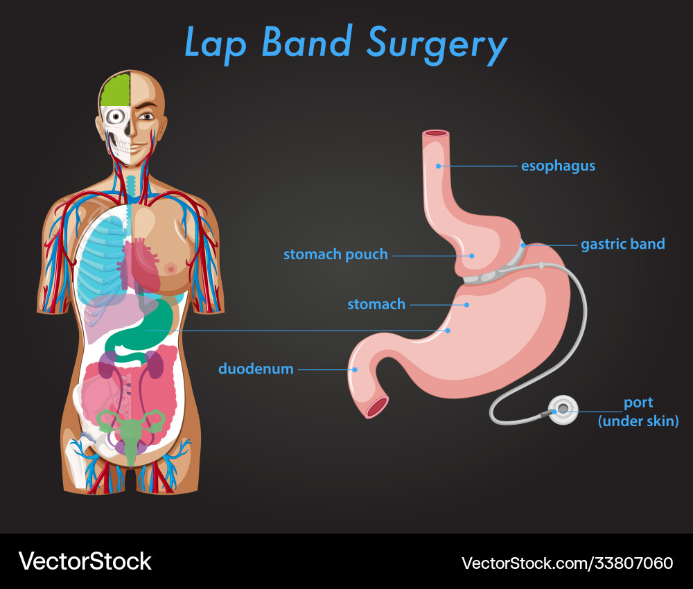 Lap band surgery anatomy Royalty Free Vector Image