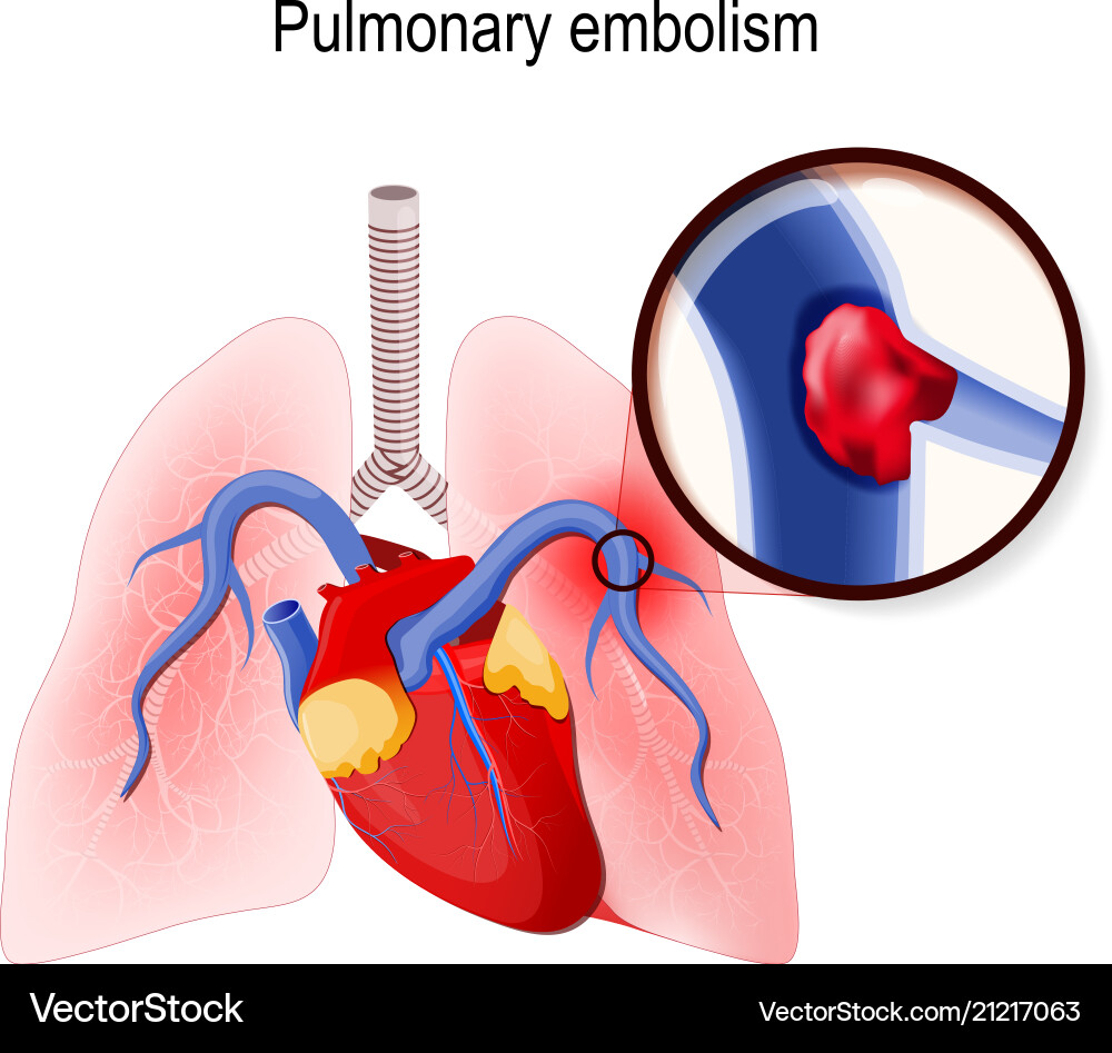 Embolus Vector Images (61)