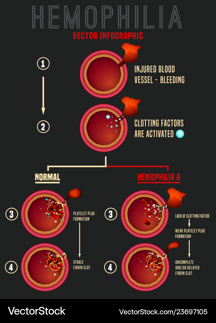 Hemophilia blood clotting process Royalty Free Vector Image
