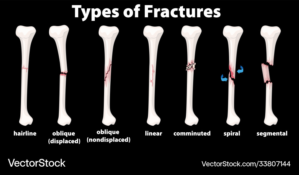 Type fractures diagram Royalty Free Vector Image