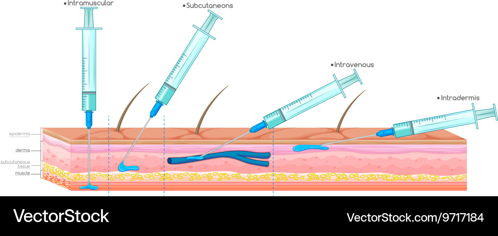 Intravenous Injection Diagram