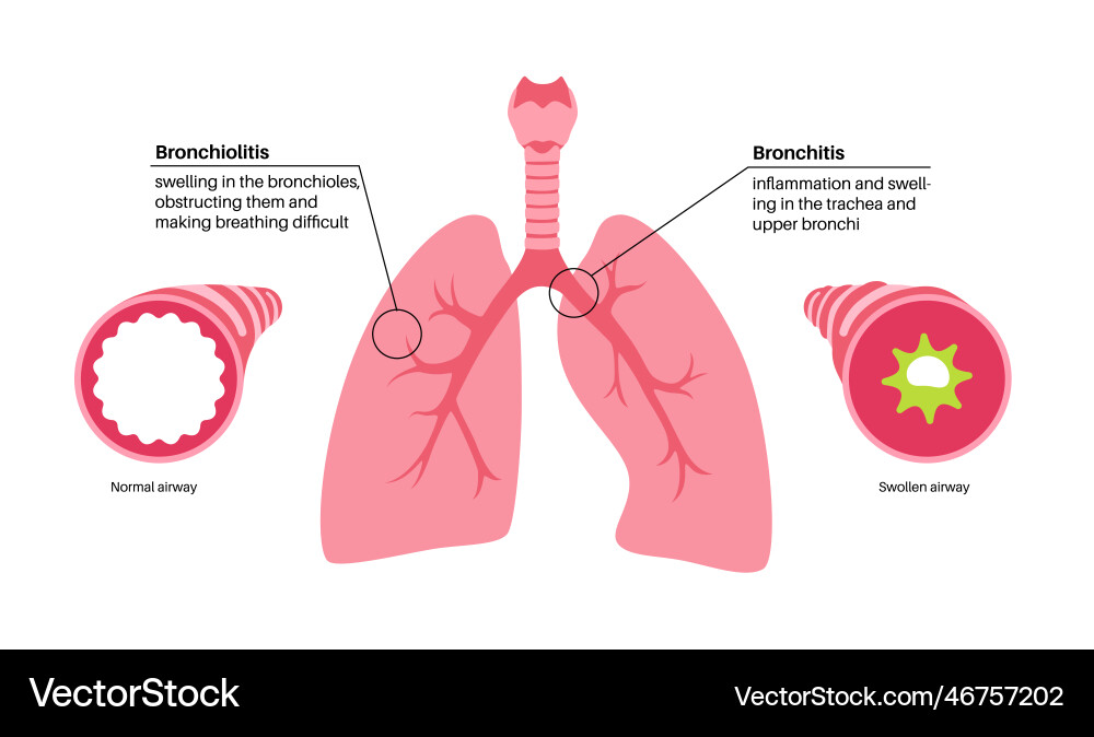 Bronchitis and bronchiolitis Royalty Free Vector Image