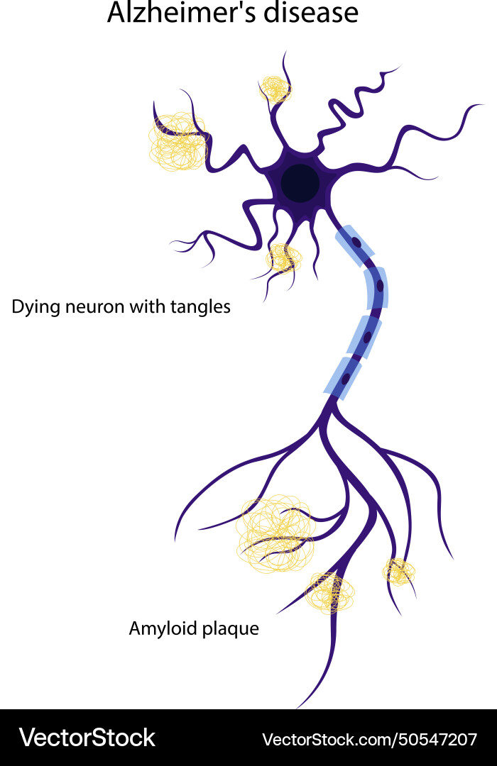 Damaged neuron the structure of a diseased Vector Image