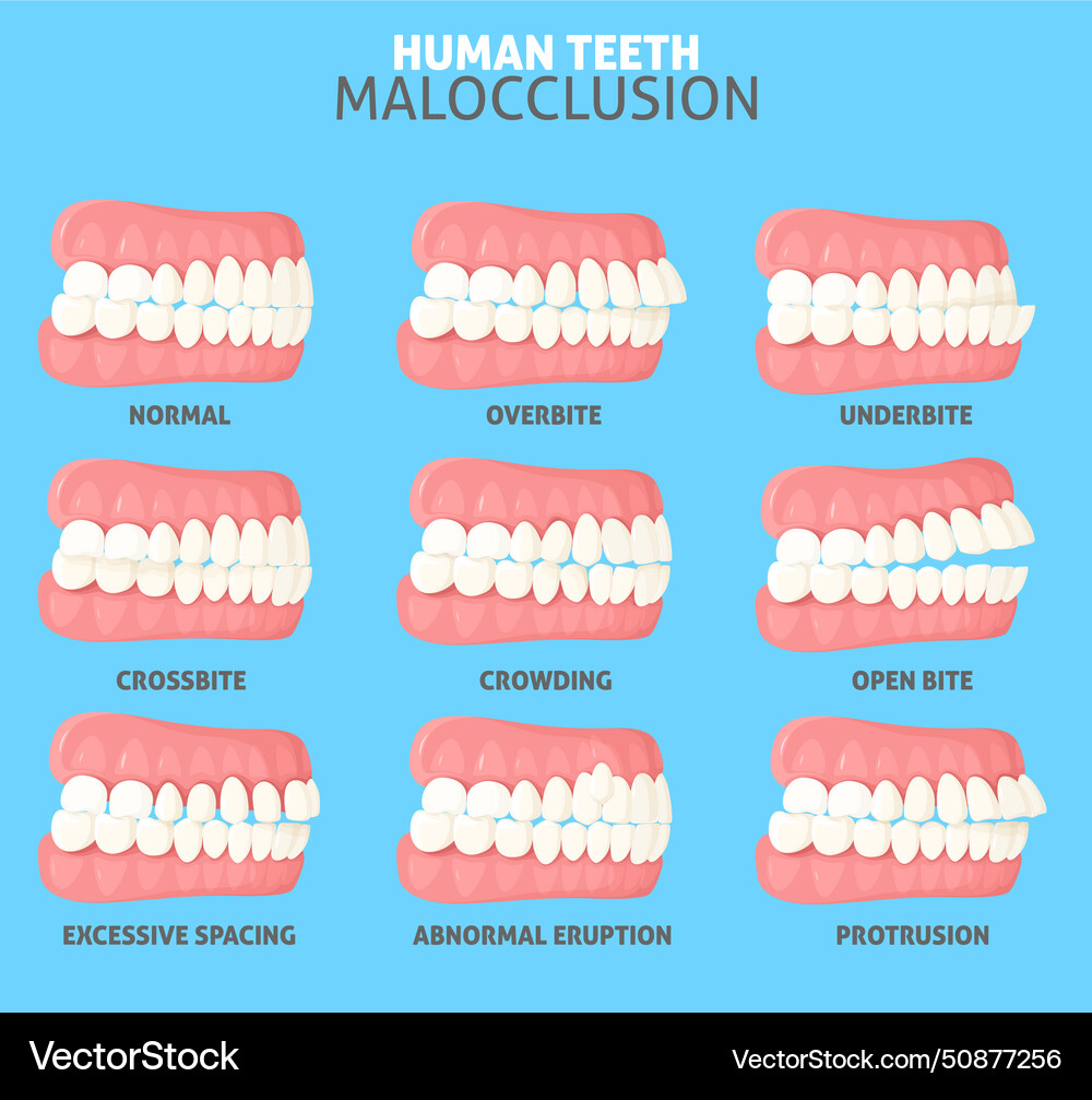 Malocclusion types side view dentist medical Vector Image