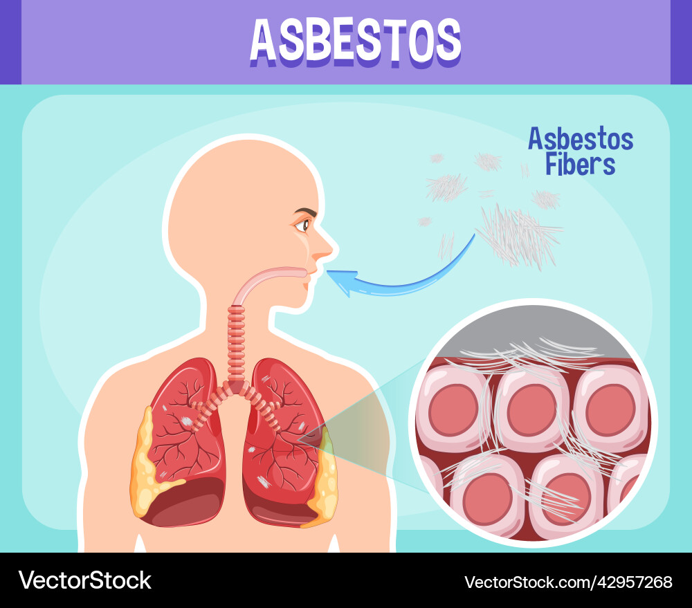 Diagramm mit Asbestose in Lungen Lizenzfreies Vektorbild