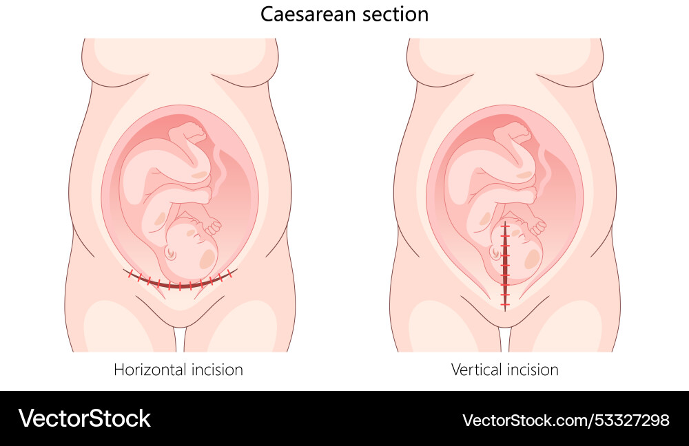 Caesarean section horizontal vertical incisions Vector Image