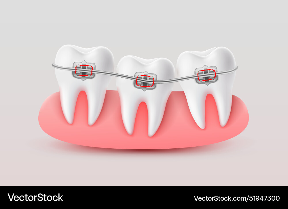 Installing braces on teeth straightening crooked Vector Image