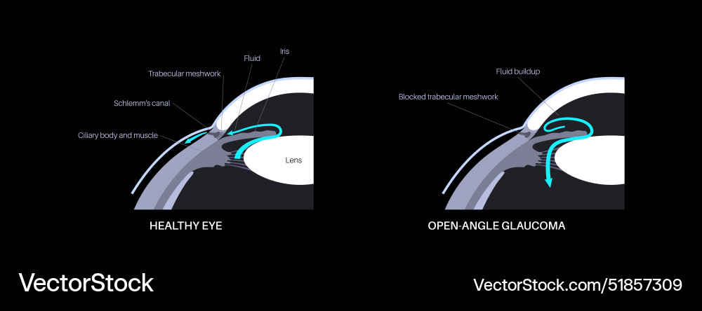 Glaucoma eye disease Royalty Free Vector Image