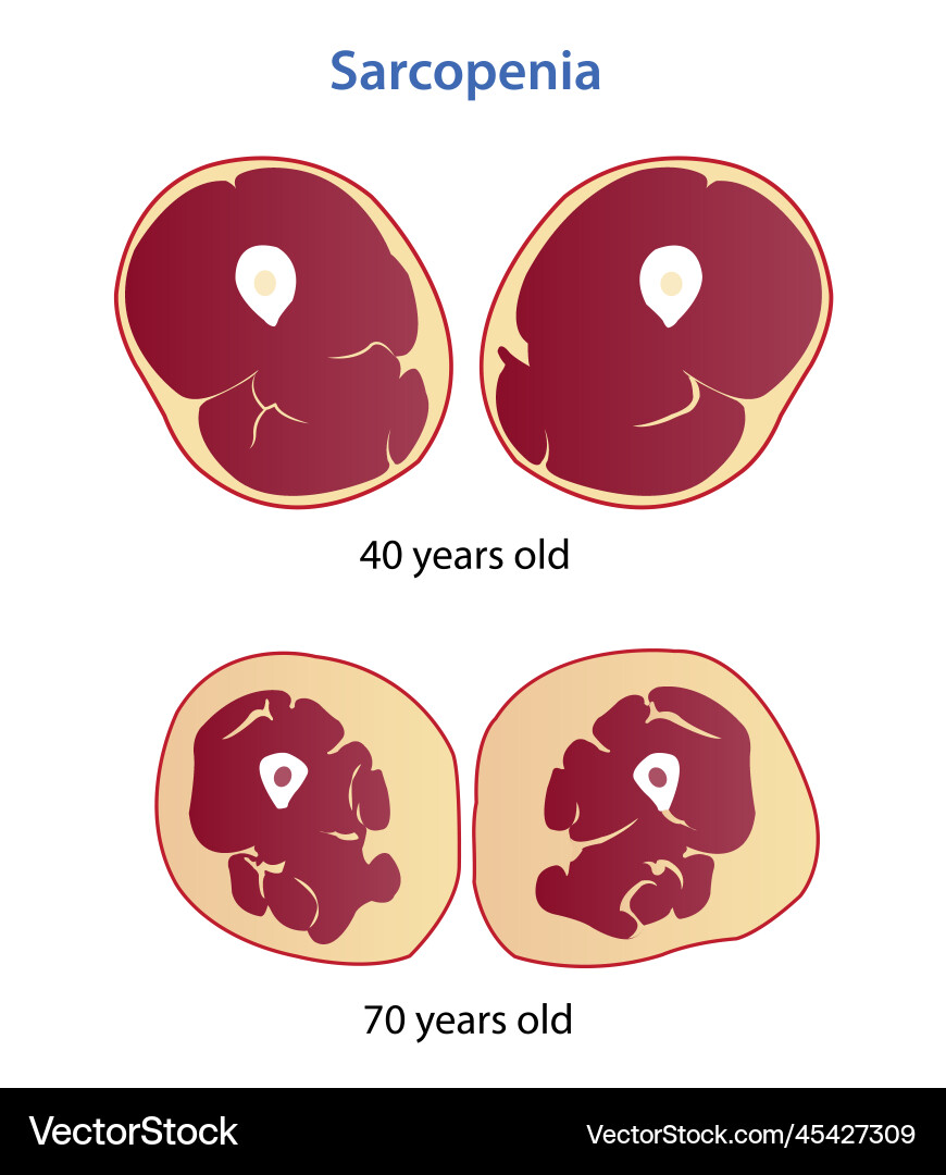 Sarcopenia Royalty Free Vector Image - VectorStock
