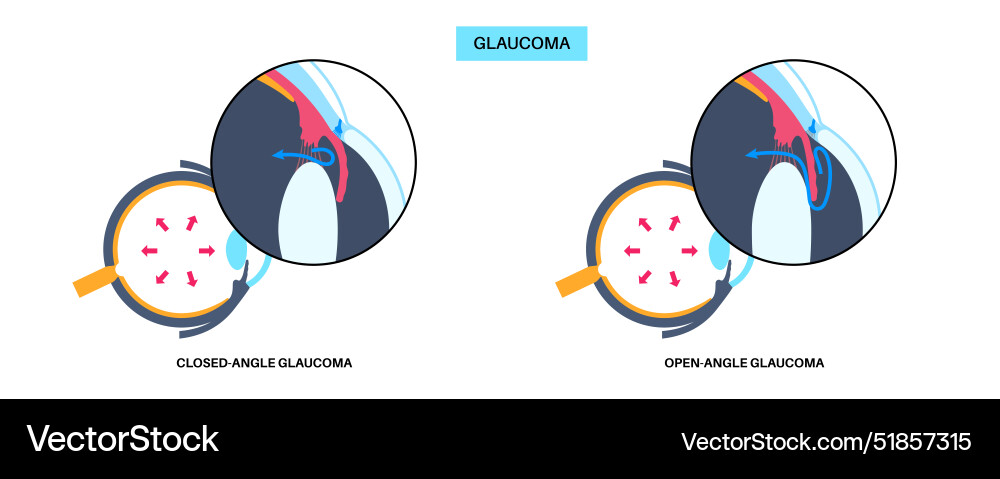 Glaucoma eye disease Royalty Free Vector Image