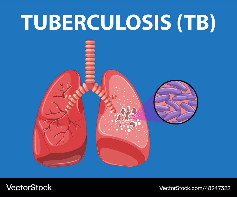 Human Lung Anatomy With Tuberculosis Infographic Vector Image