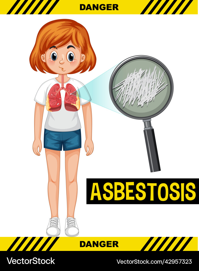 Diagramm mit Asbestose in Lungen Lizenzfreies Vektorbild
