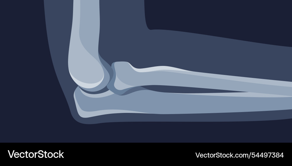 Elbow xray roentgen image orthopedic diagnosis Vector Image