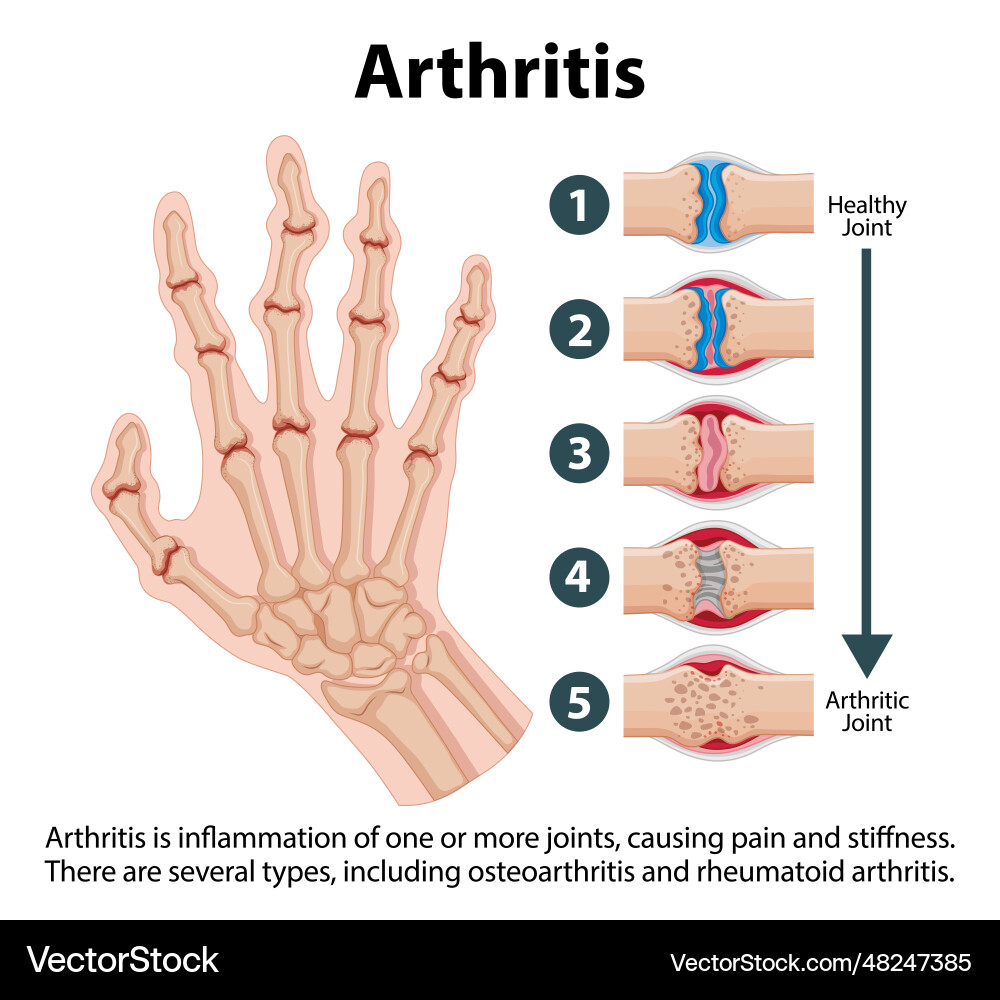 Science education human anatomy and arthritis Vector Image