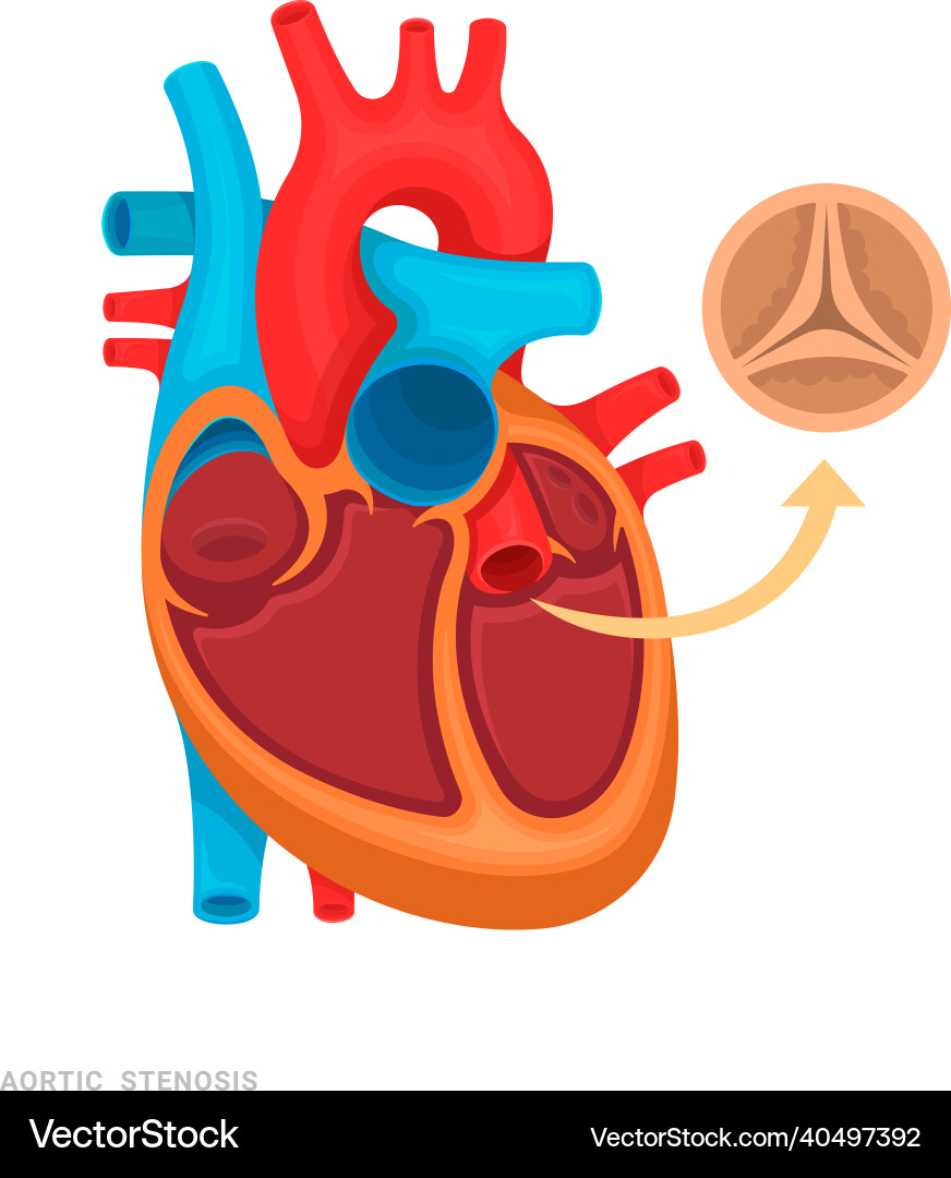 Heart defect Royalty Free Vector Image - VectorStock