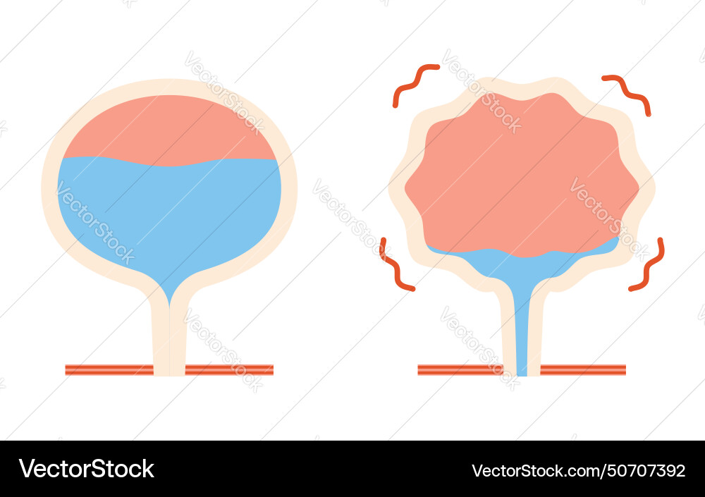Medical of overactive bladder normal vs Royalty Free Vector