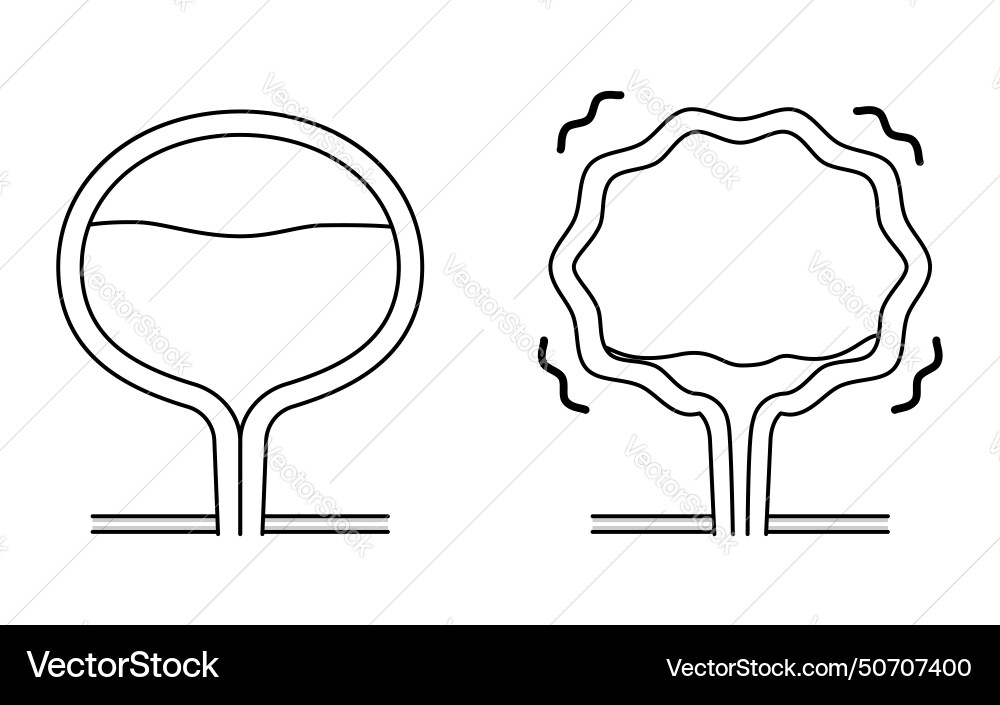 Medical of overactive bladder normal vs Royalty Free Vector