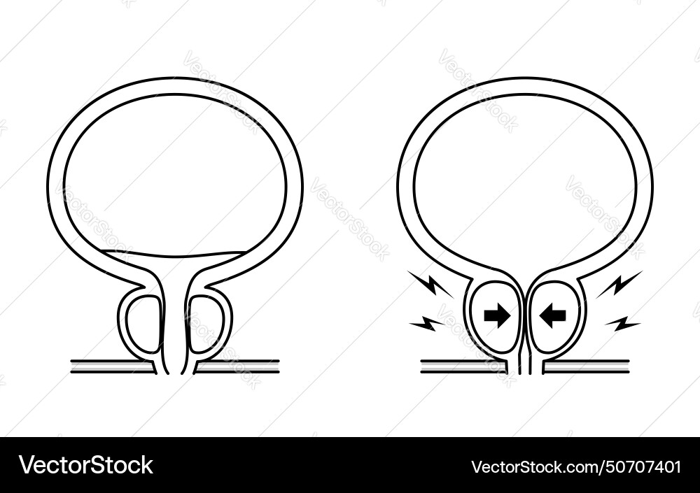 Medical of benign prostatic hyperplasia normal vs Vector Image