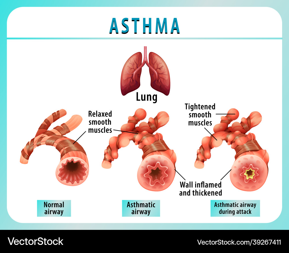 Bronchial asthma diagram with normal airway Vector Image