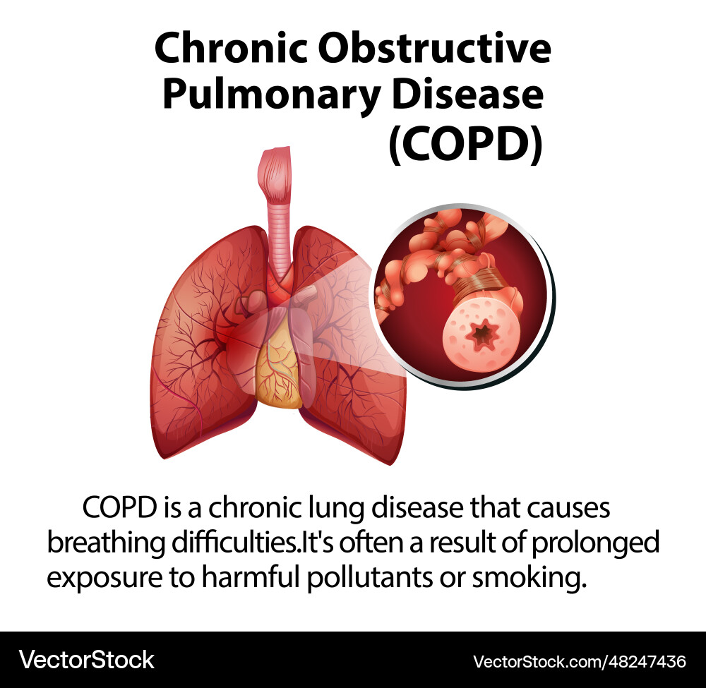 Science education of human anatomy copd Royalty Free Vector